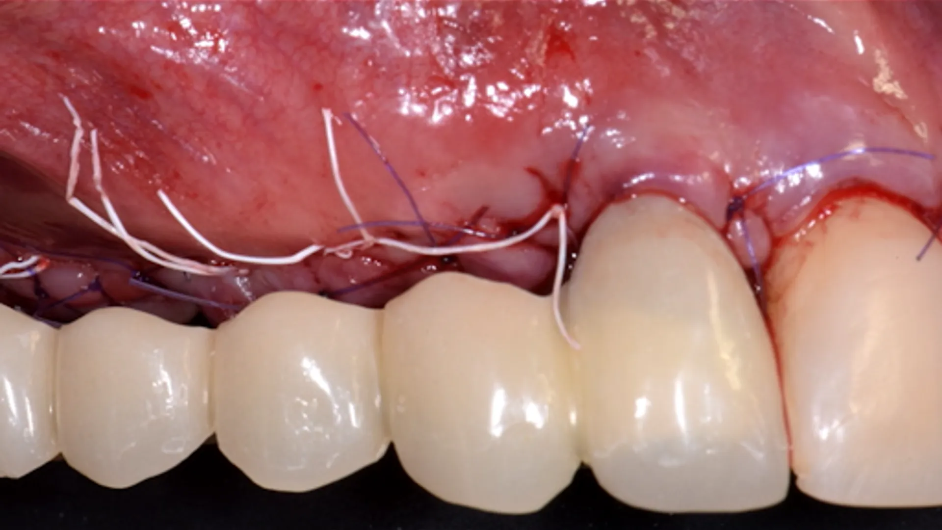 Low window technique