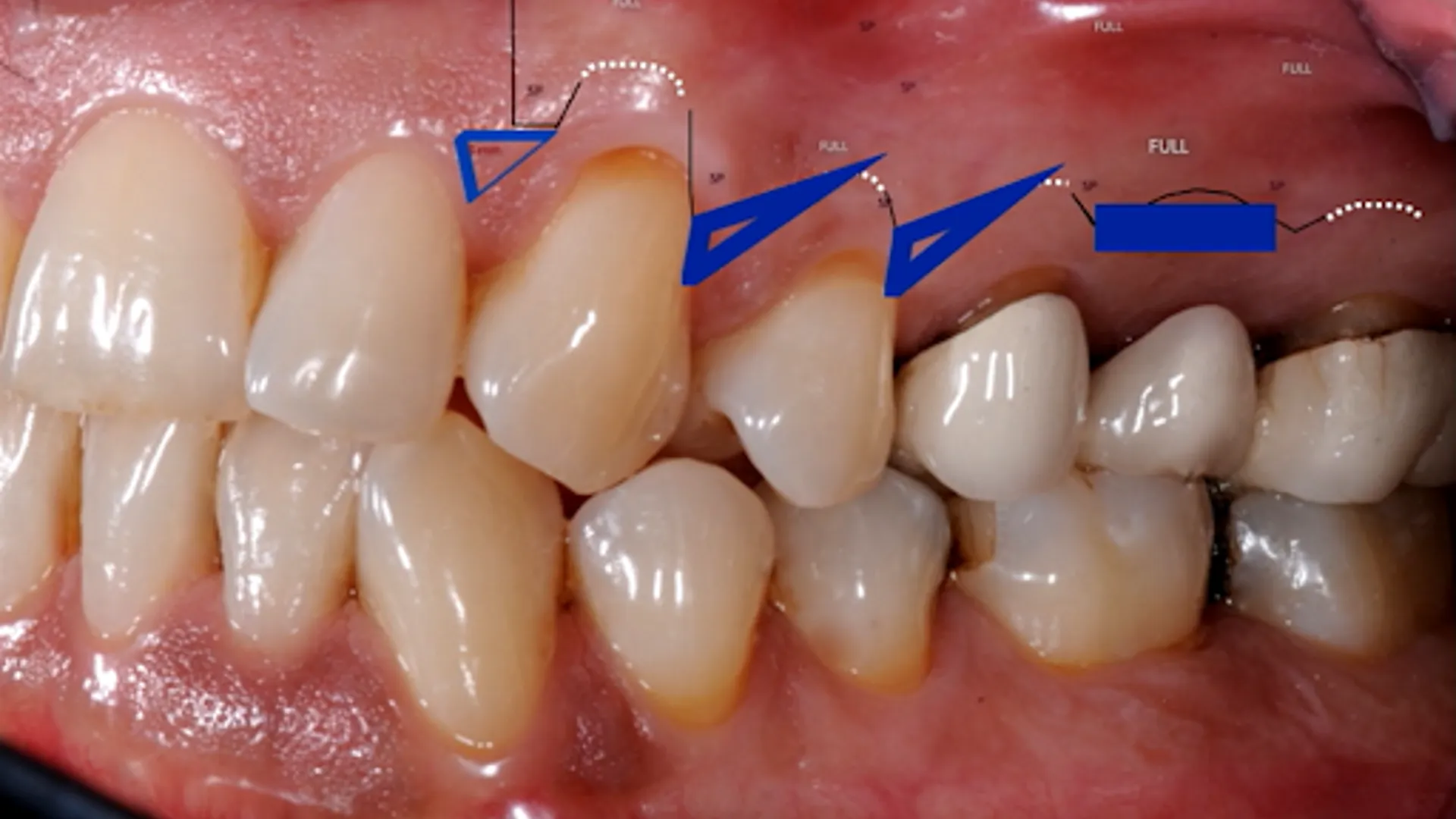 Implant site preparation, flap incision and suture protocol