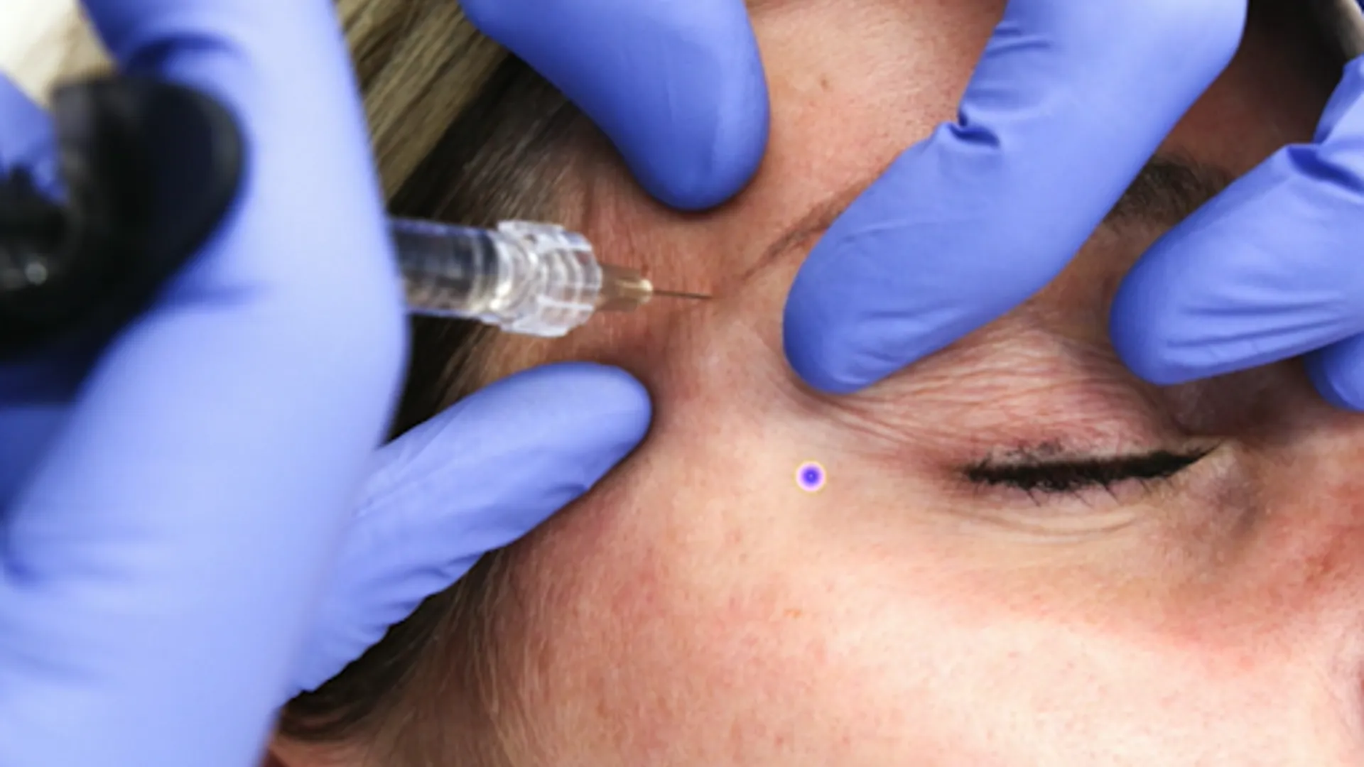 The full-face treatment: step-by-step description of a clinical case
