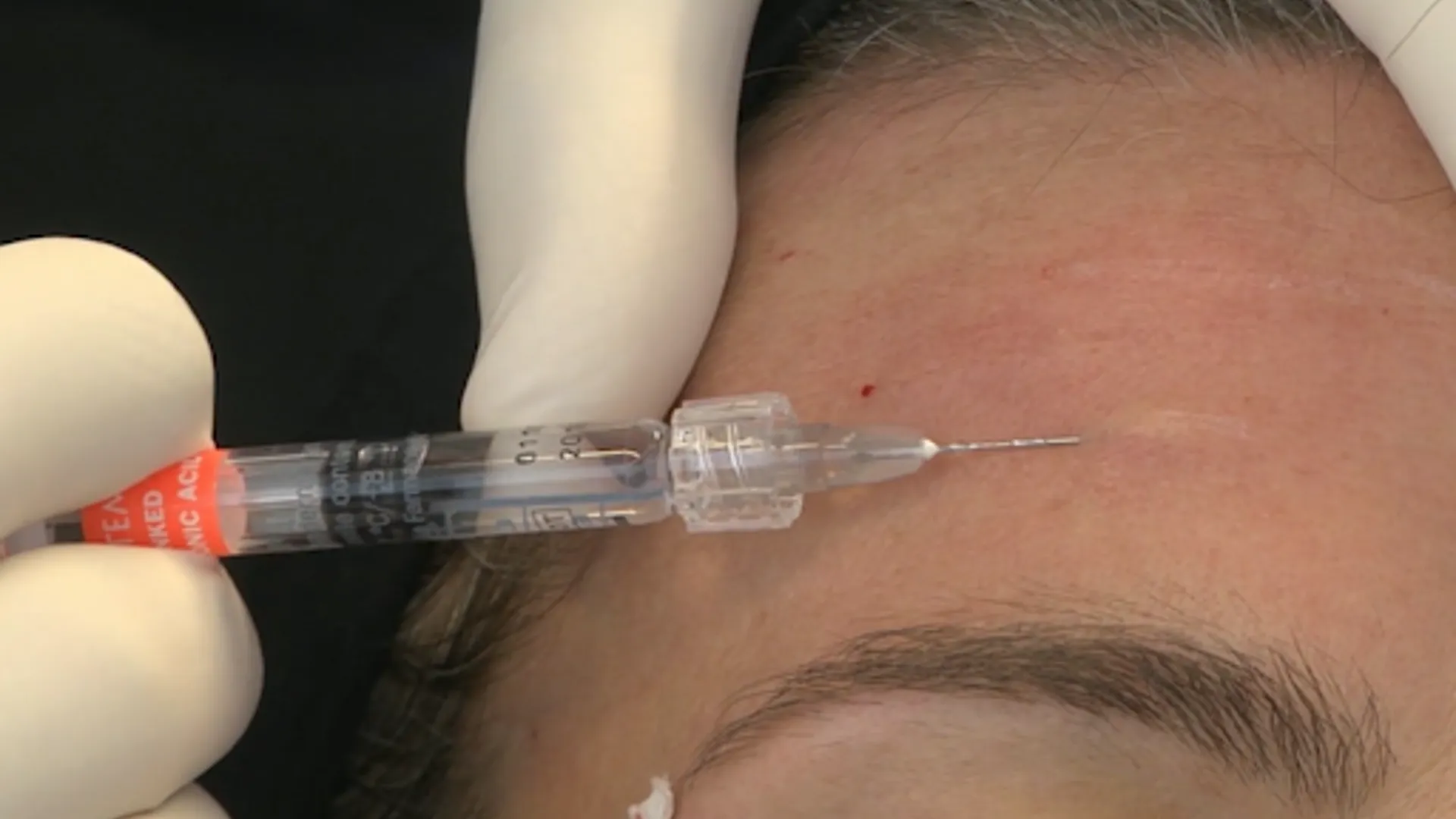 Upper third of the face