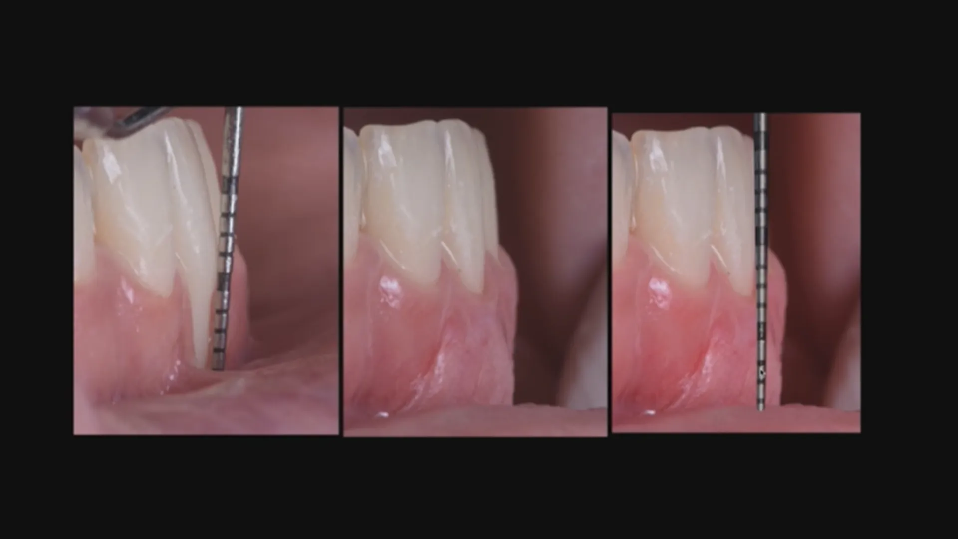 Gingival recessions of the lower incisors (Pt.1)