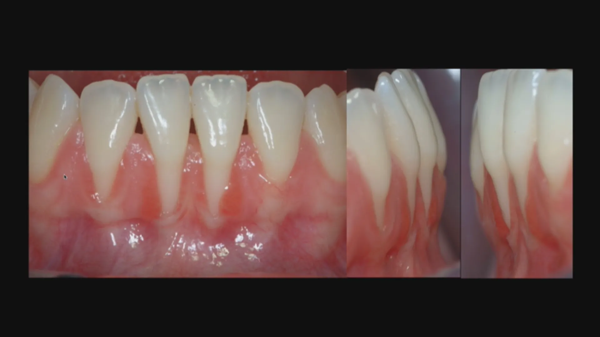 Surgical treatment of lower incisors gingival recessions