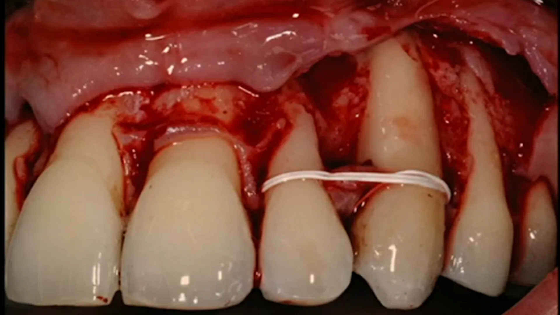 The evolution of the technique