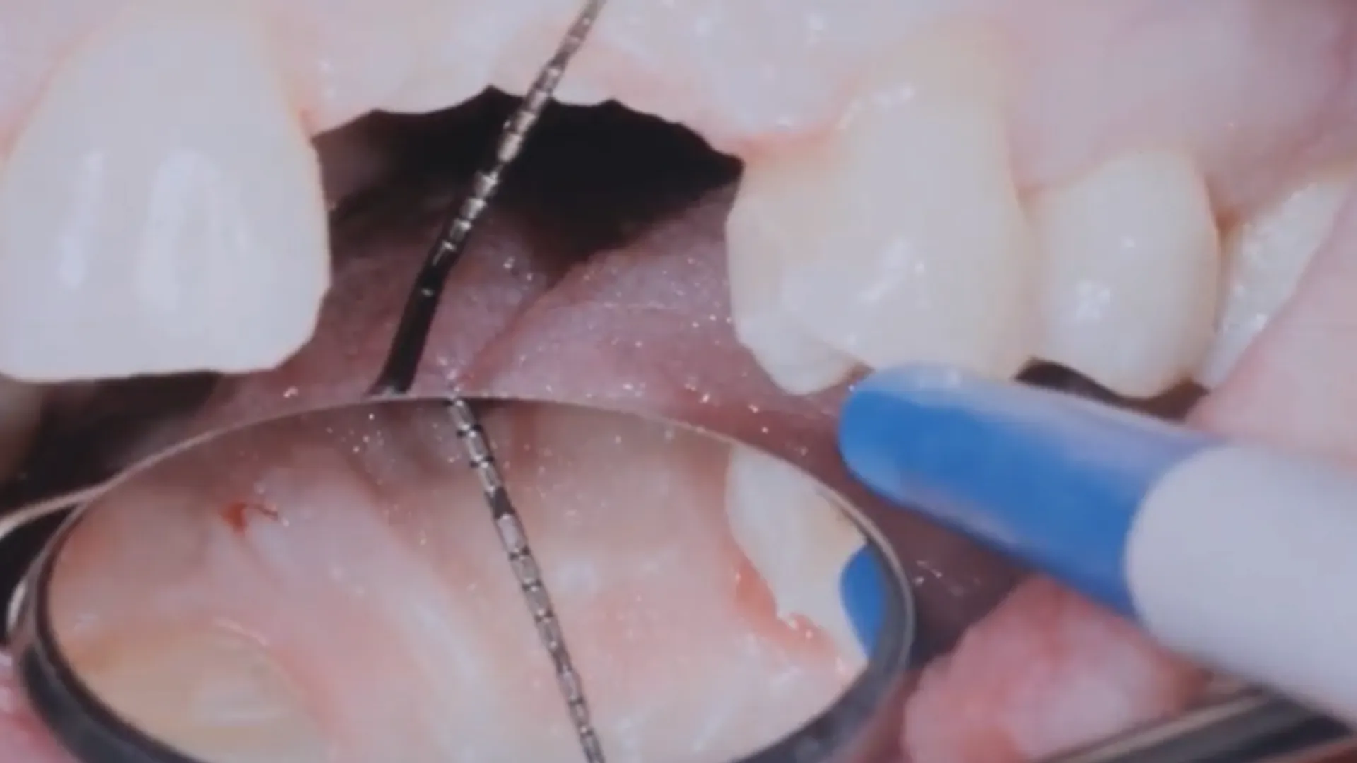 Vertical bone regeneration in the aesthetic zone: which technique to adopt?