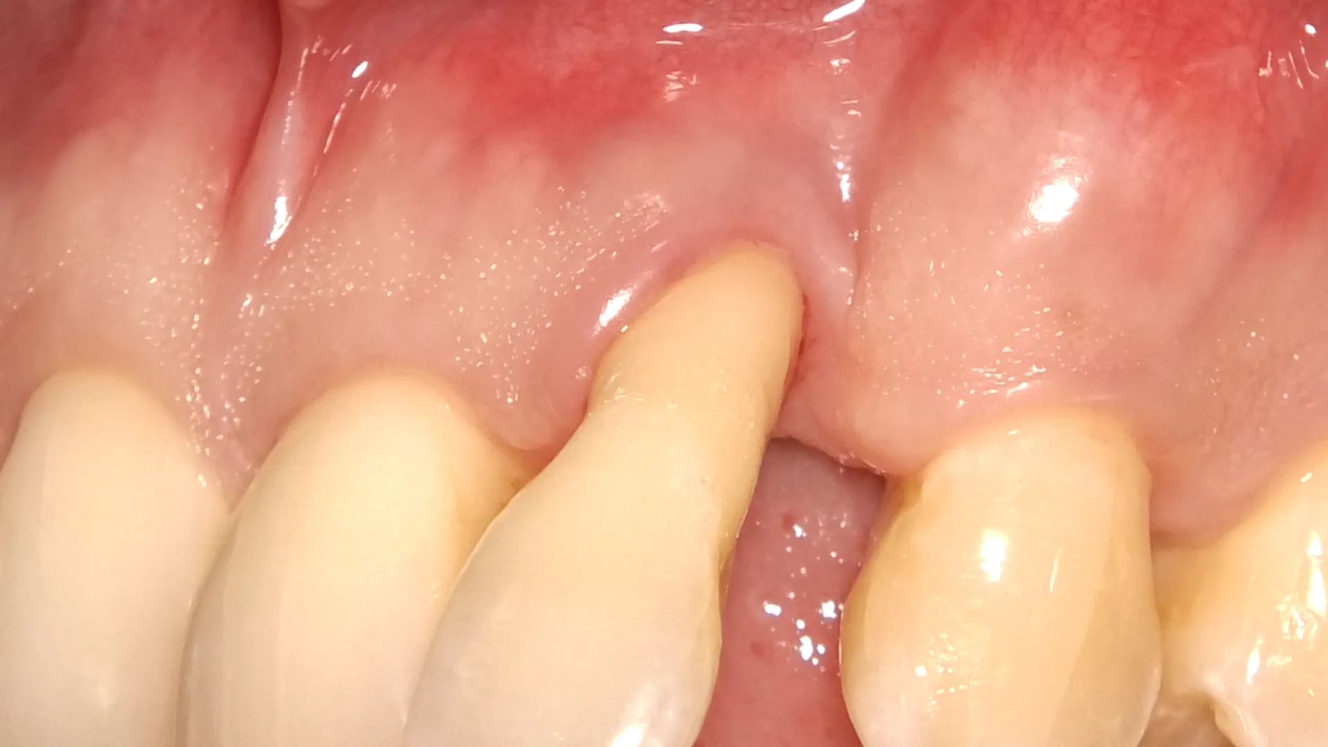 Renewals 2025 - Coronal Advancement for a Deep Defect on Lateral ...