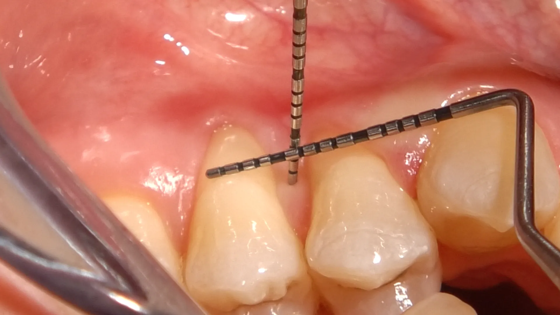 Renewals 2025 - Management of the Thin Papilla between the Two ...