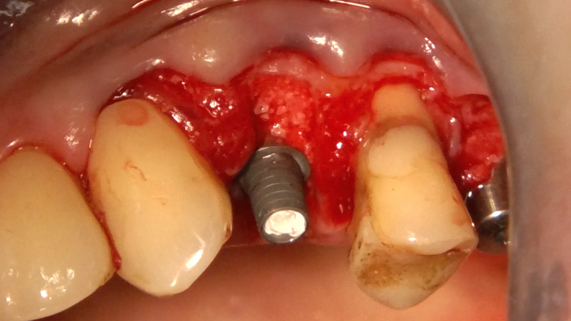 Renewals 2025 - Immediate Post-Extraction Implant of the First Premolar ...