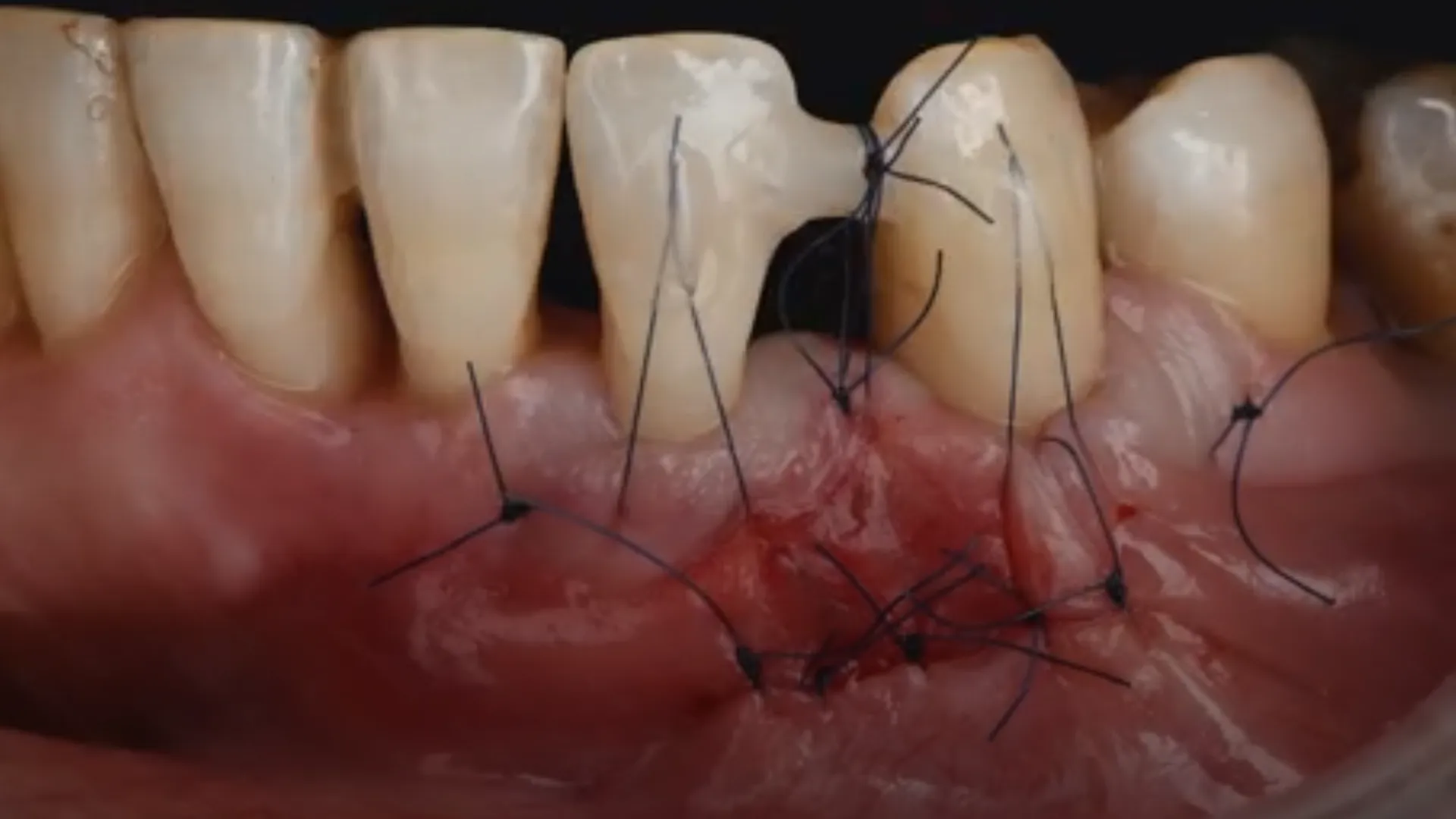 Periodontitis: the sixth most common disease in humanity