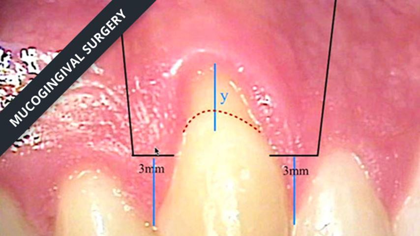 Coronally advanced flap with vertical releasing incisions (trapezoidal ...