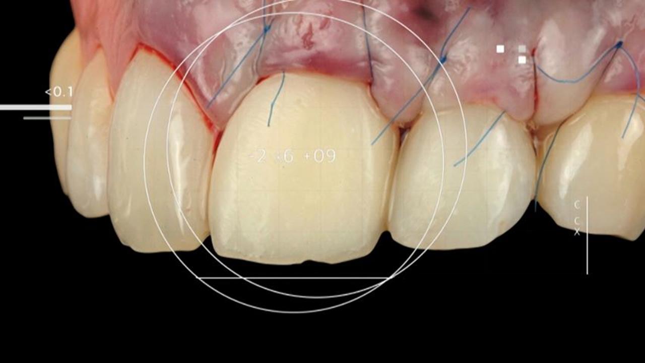 Periodontal surgery around natural teeth: a prosthodontist perspective