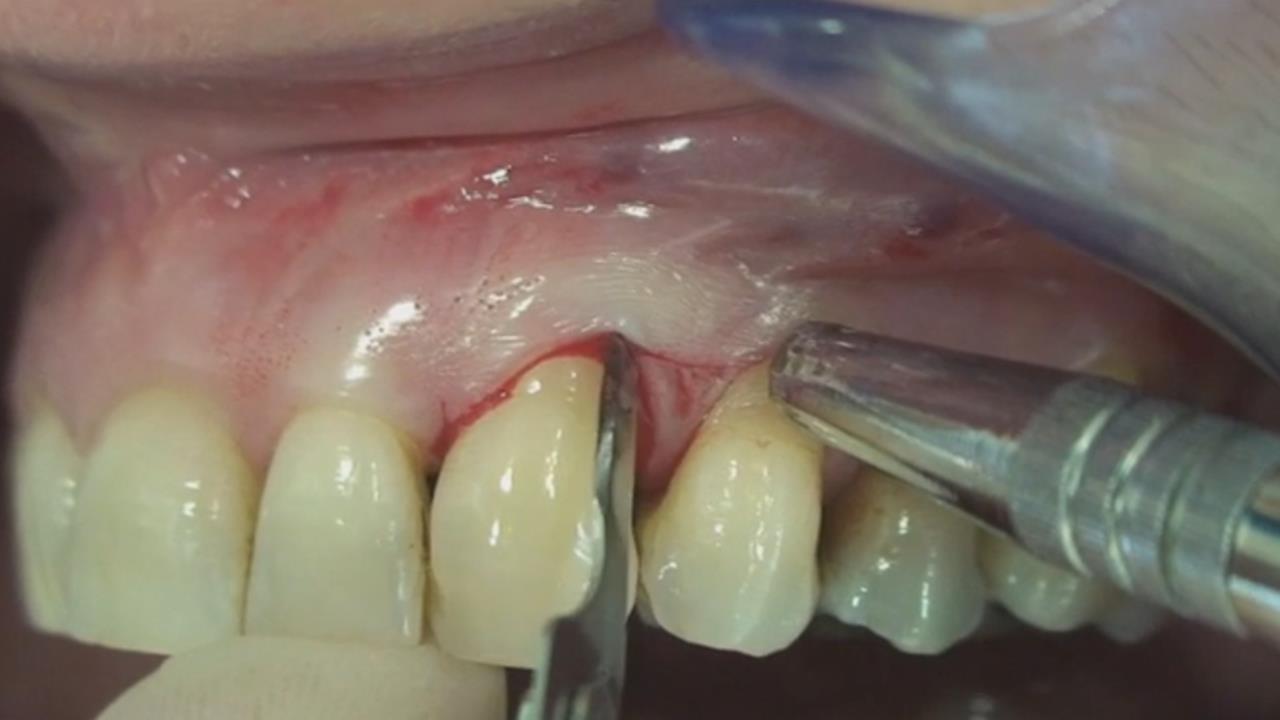 The Surgical Technique for EMD